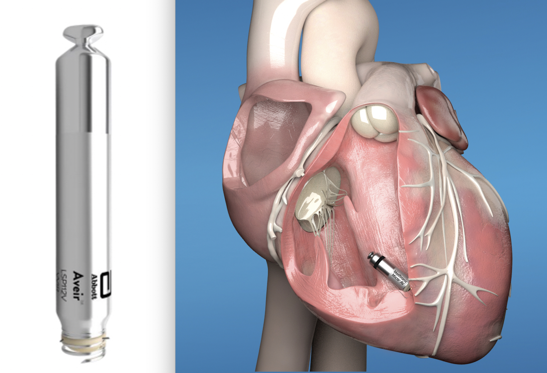 Stimulateur Cardiaque 5 Key Ways To Look After Your New Pacemaker
